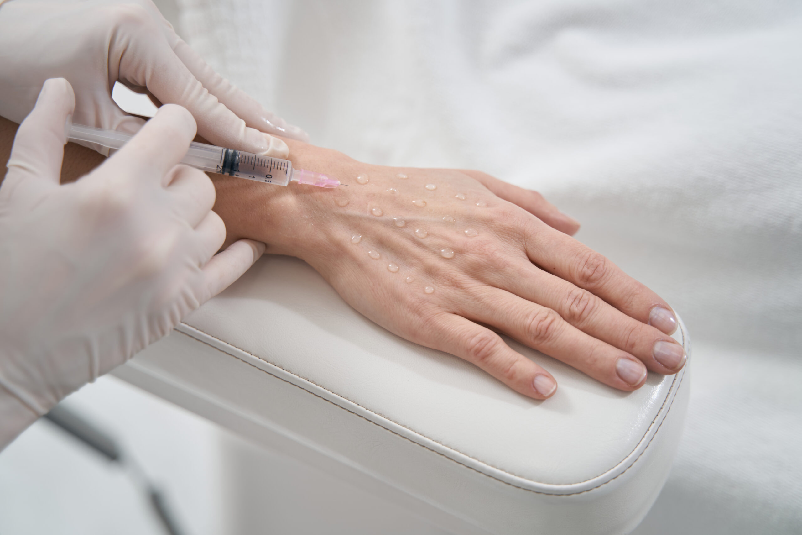Sclerotherapy for Hand Veins: Safe, Effective Treatment